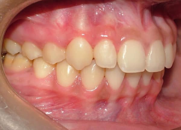 Retruded Maxillary Incisors And Missing Lower Canine - Smiles N Faces