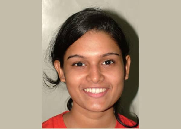 Retruded Maxillary Incisors And Missing Lower Canine - Smiles N Faces