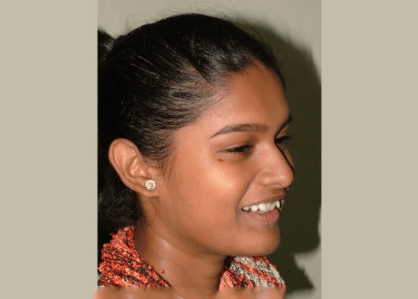 Retruded Maxillary Incisors And Missing Lower Canine - Smiles N Faces